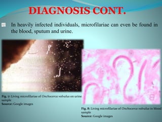 Onchocerciasis | PPTX