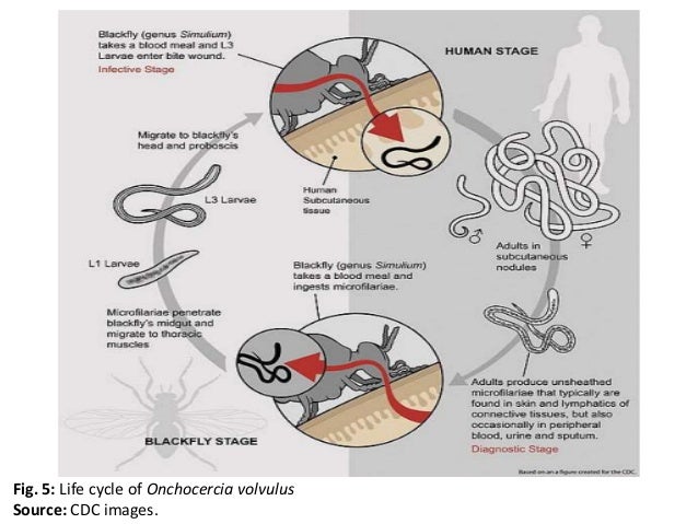 Onchocerciasis