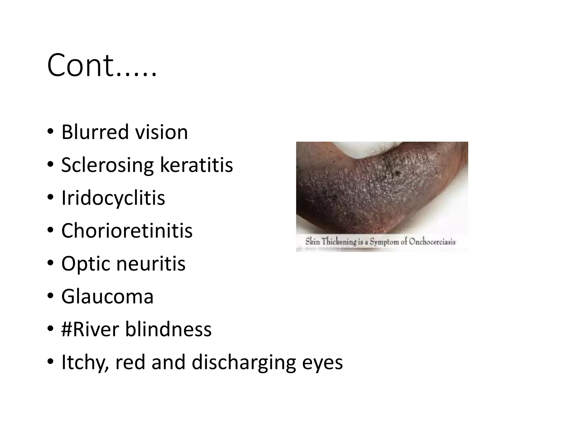 Onchocerciasis | PPTX