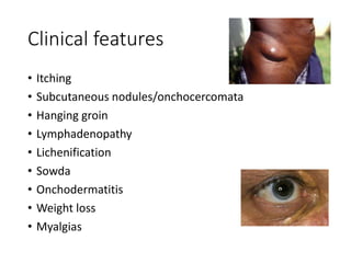 Onchocerciasis | PPTX