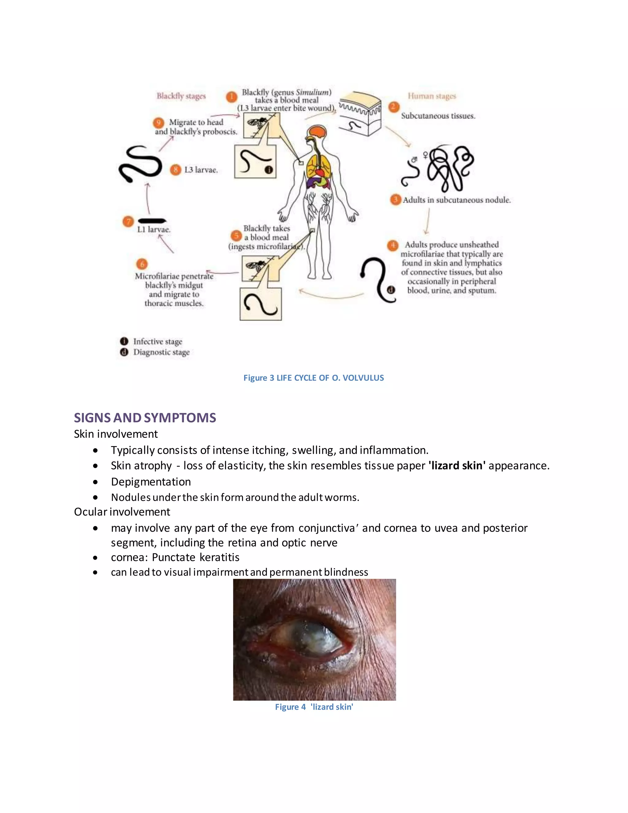 Onchocerciasis | DOCX