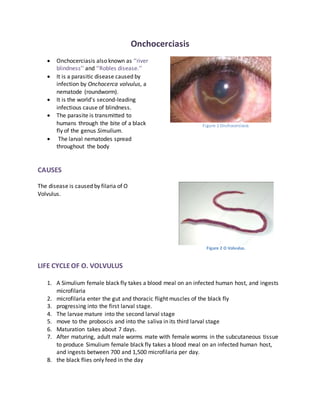 Onchocerciasis Adalah