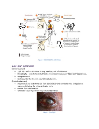 Onchocerca Volvulus Eye