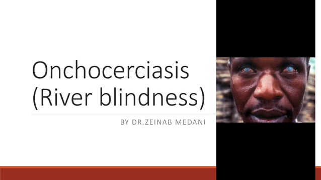 Onchocerciasis.pptx | Skin and Dermatology | Diseases and Conditions