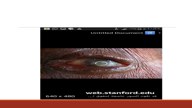 Onchocerciasis.pptx | Skin and Dermatology | Diseases and Conditions