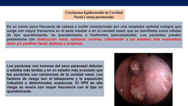 Cancer de cavidad nasal y senos paranasales | PPTX