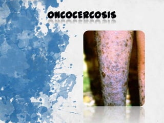Oncocercosis | PPTX