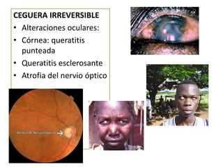 Oncocercosis. | PPTX