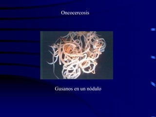 Oncocercosis abril 27.ppt