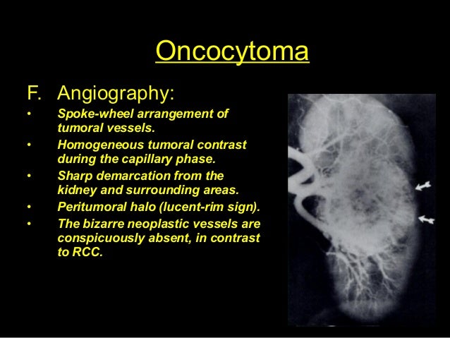 Oncocytoma