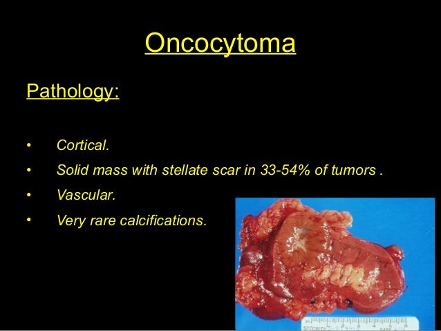 Oncocytoma