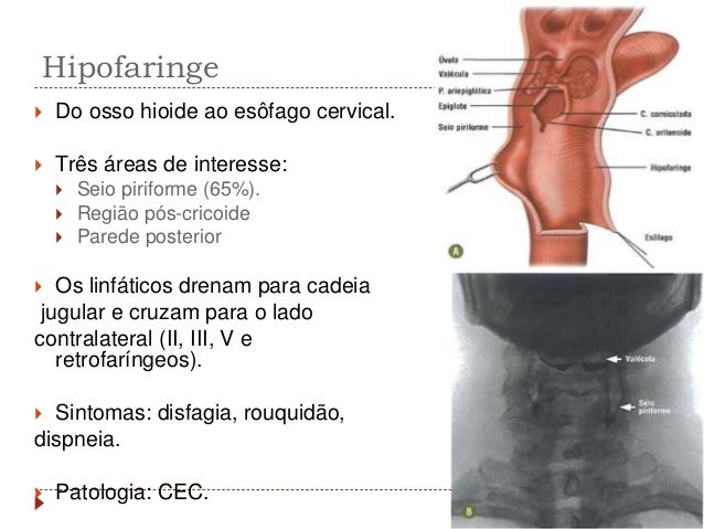 Oncologia cbr â€“ faringe, laringe, cavidade