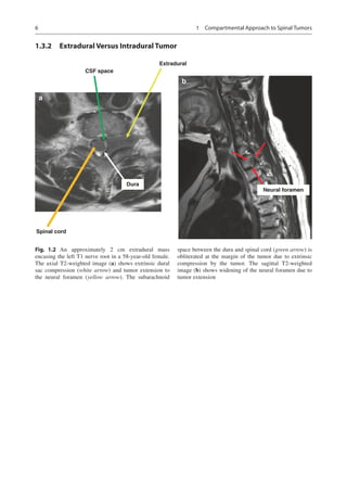Oncologic Imaging Spine and Spinal Cord Tumors.pdf