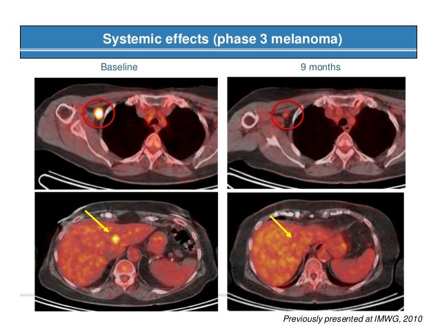 Talimogene laherparepvec (T-VEC, OncoVEX GM-CSF) phase 3 data in mela…