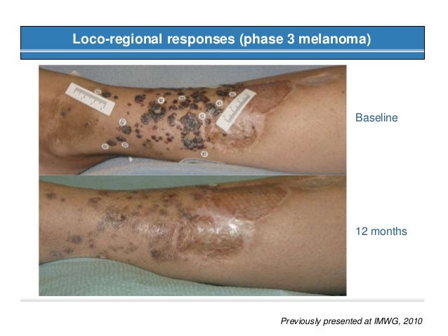 Talimogene laherparepvec (T-VEC, OncoVEX GM-CSF) phase 3 data in mela…