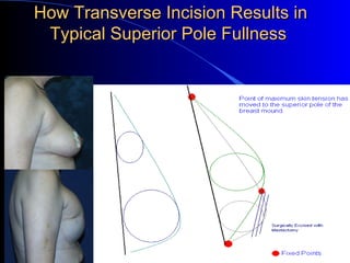 Breast Preservation Foundation: Oncoplastic Talk, Dallas, 12/5/09 | PPT