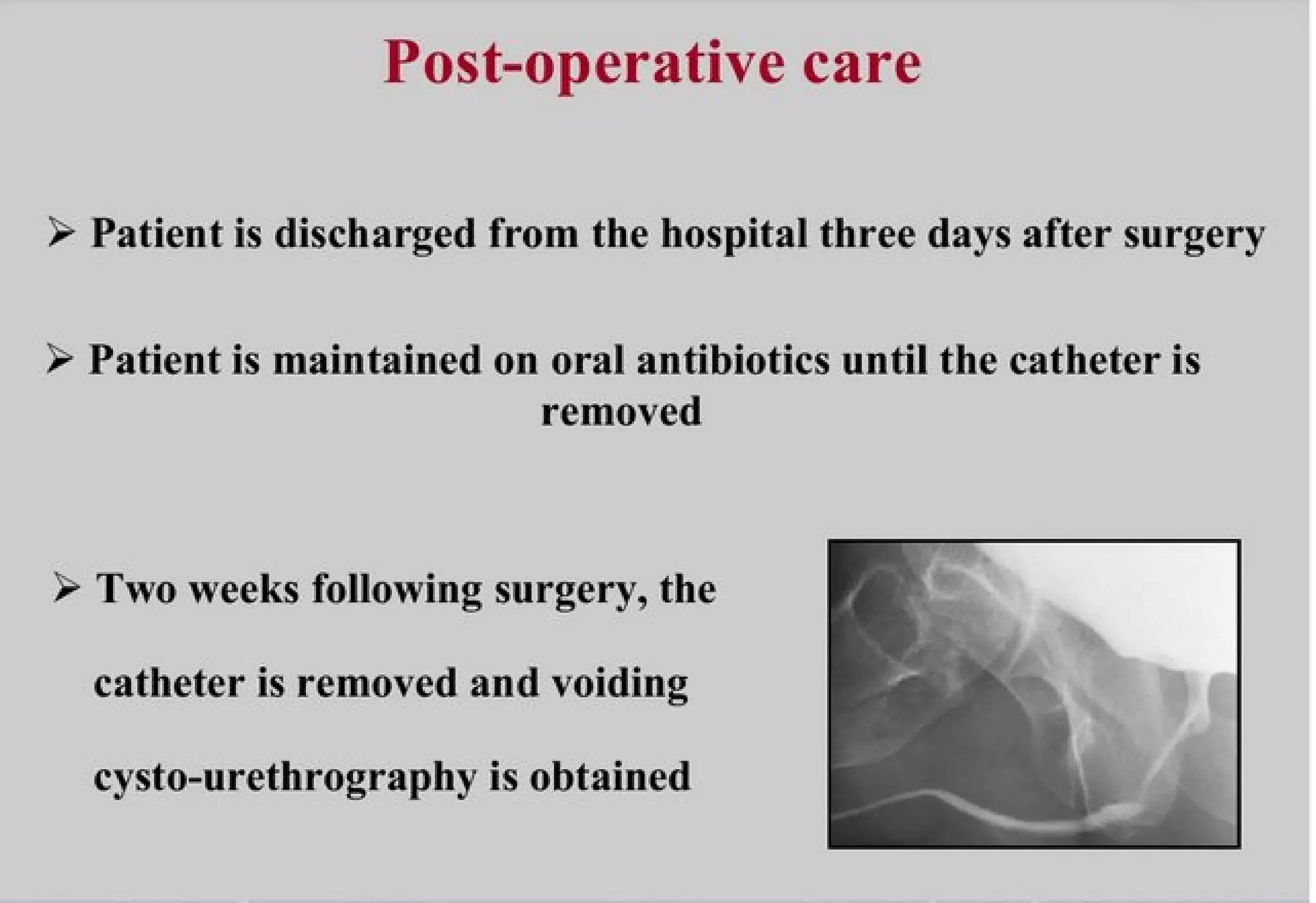 One stage urethroplasty of penile urethra using penile skin flap | PDF