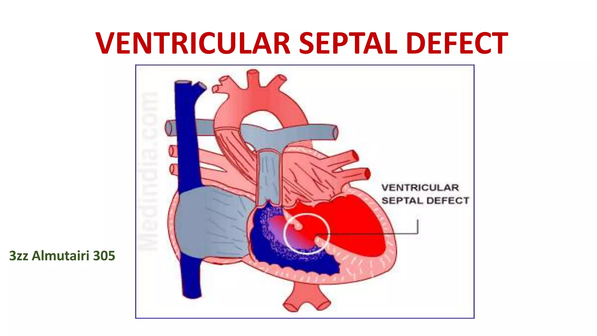 ventricular septal defect | PPTX