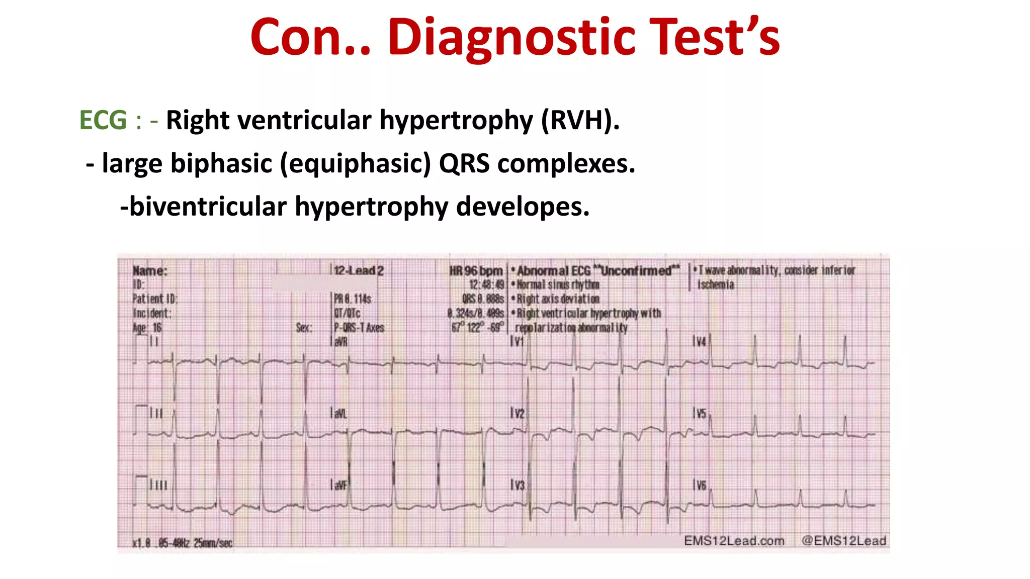 ventricular septal defect | PPTX