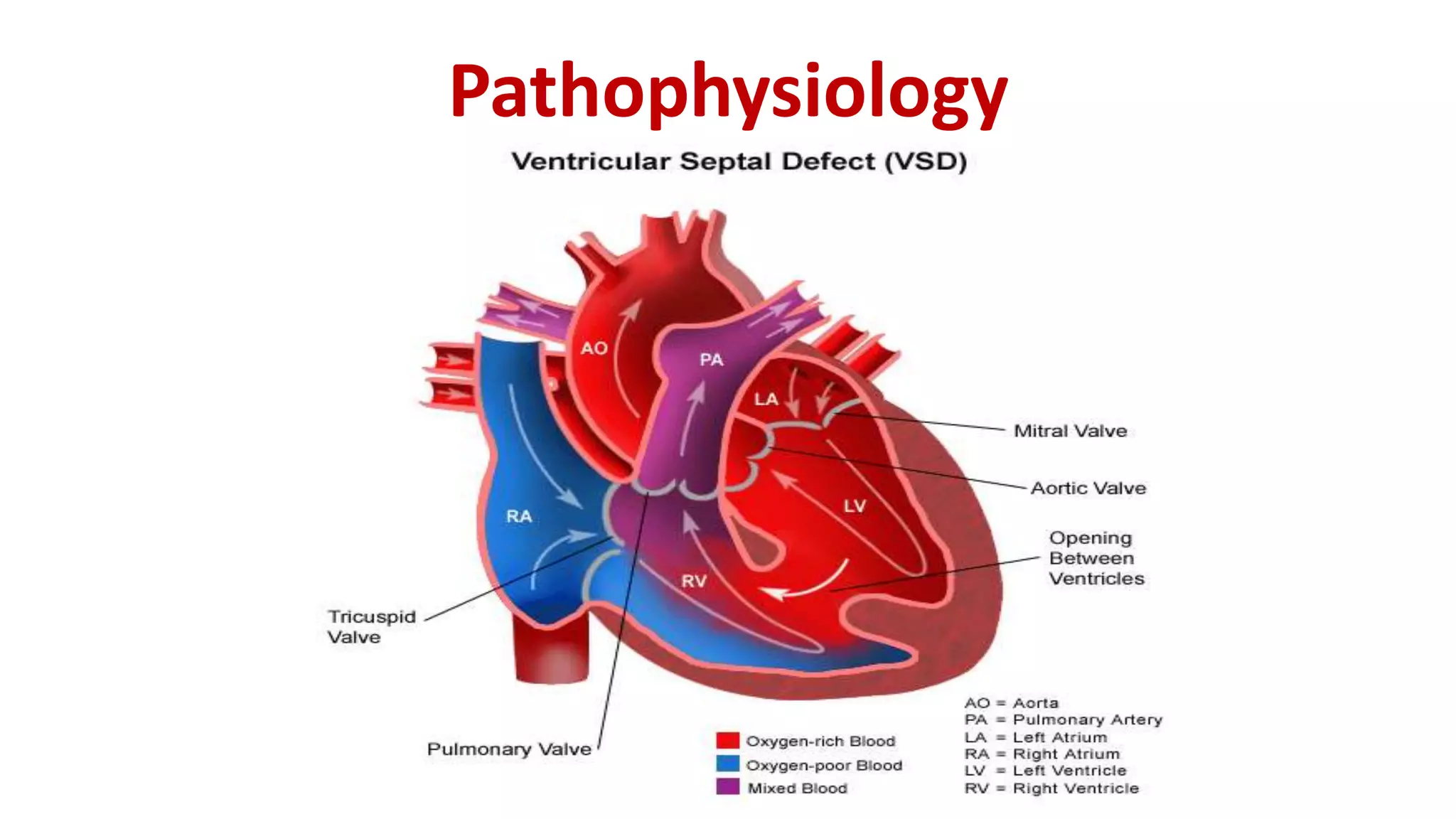 ventricular septal defect | PPTX | Heart and Cardiovascular Diseases ...
