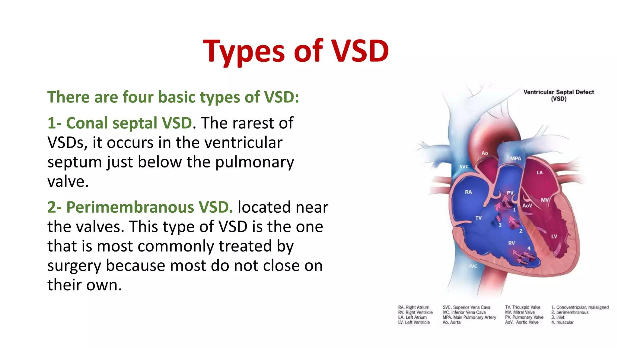 ventricular septal defect | PPTX