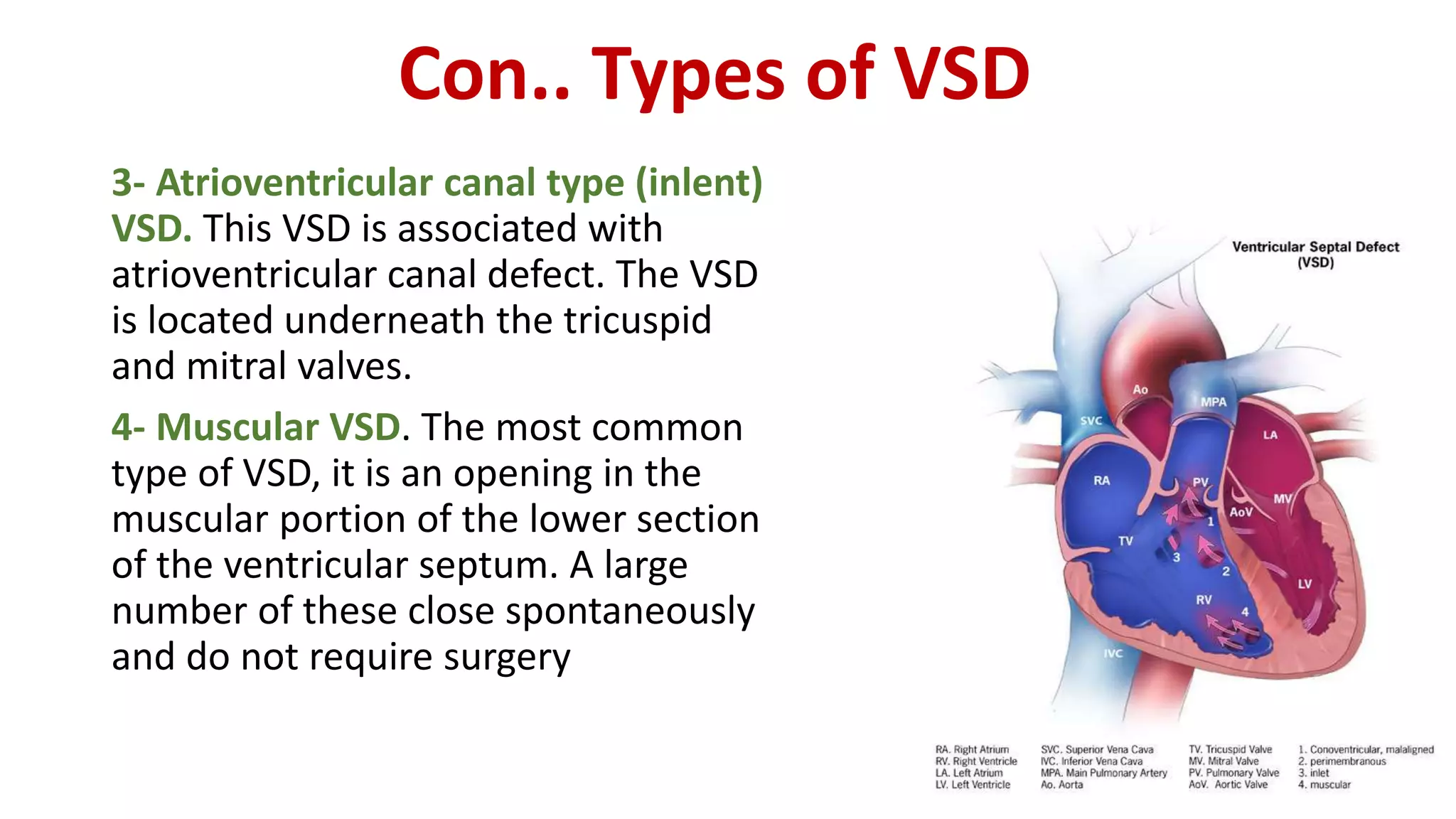 ventricular septal defect | PPTX