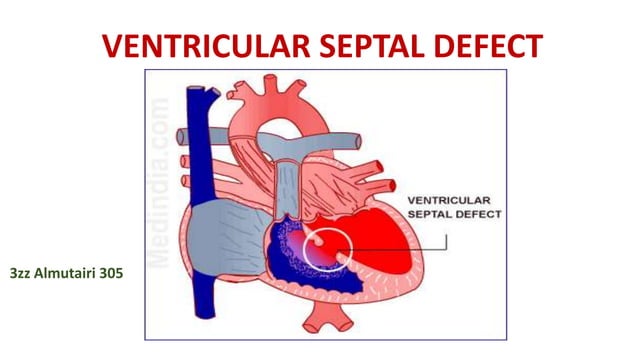ventricular septal defect | PPTX | Heart and Cardiovascular Diseases | Diseases and Conditions