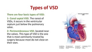 ventricular septal defect | PPT
