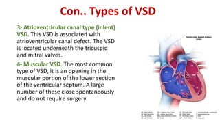ventricular septal defect | PPTX