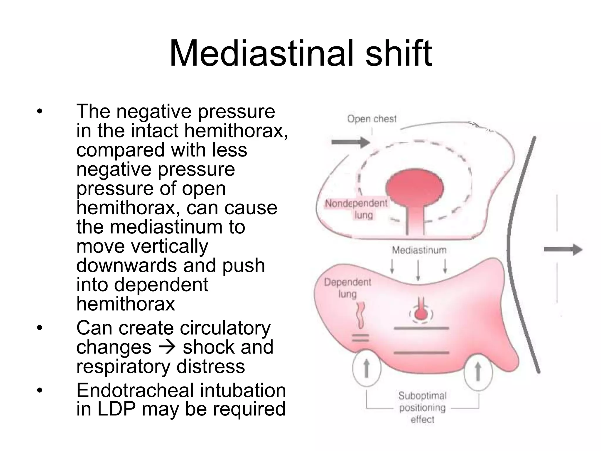 One lung ventilation | PPT