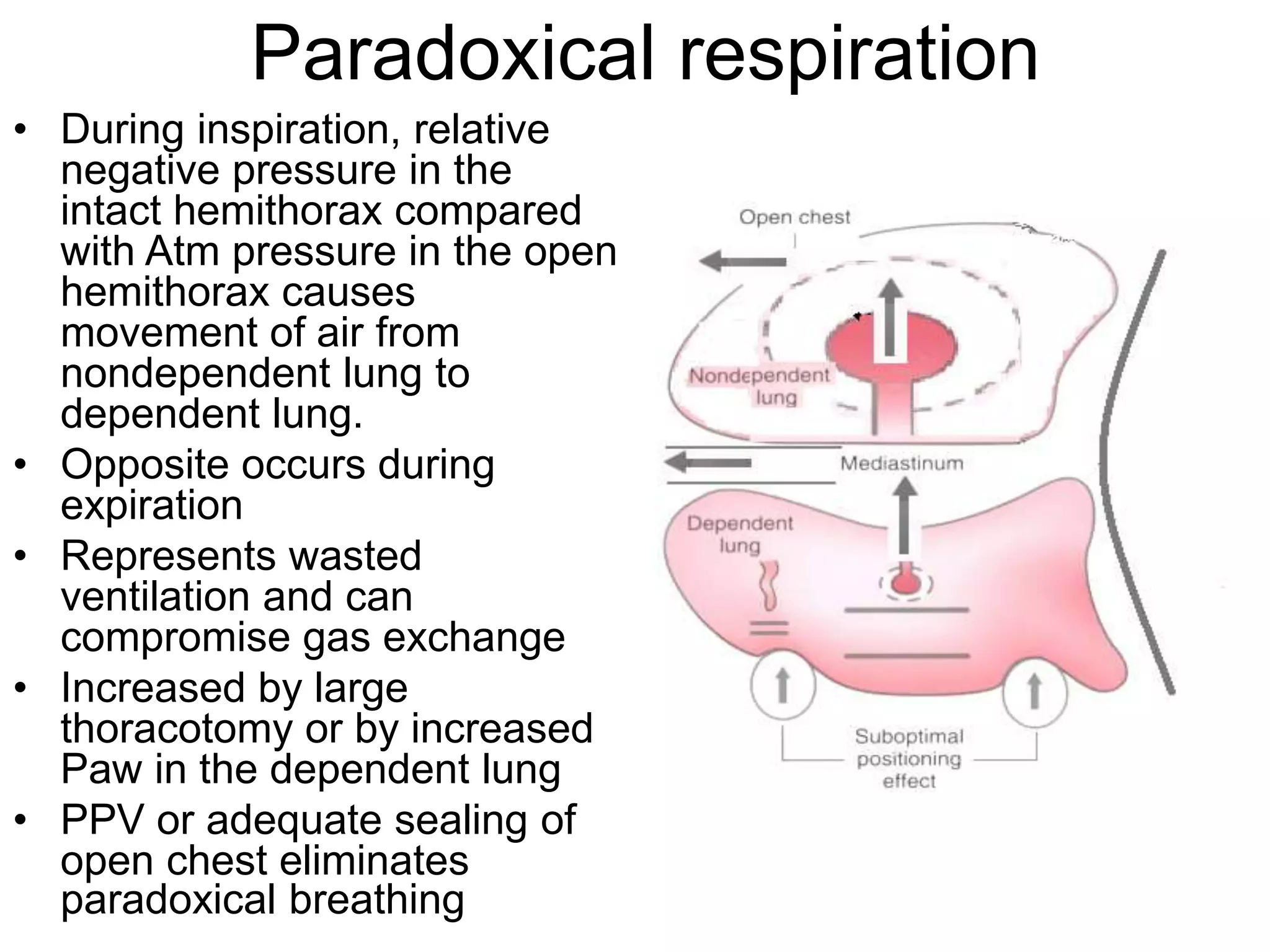 One lung ventilation | PPT