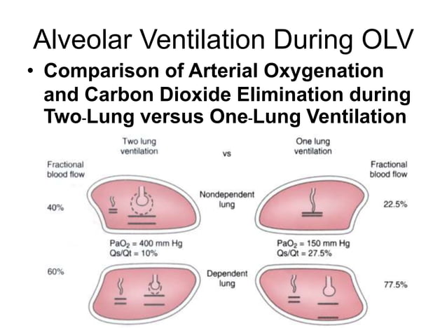 One lung ventilation | PPT