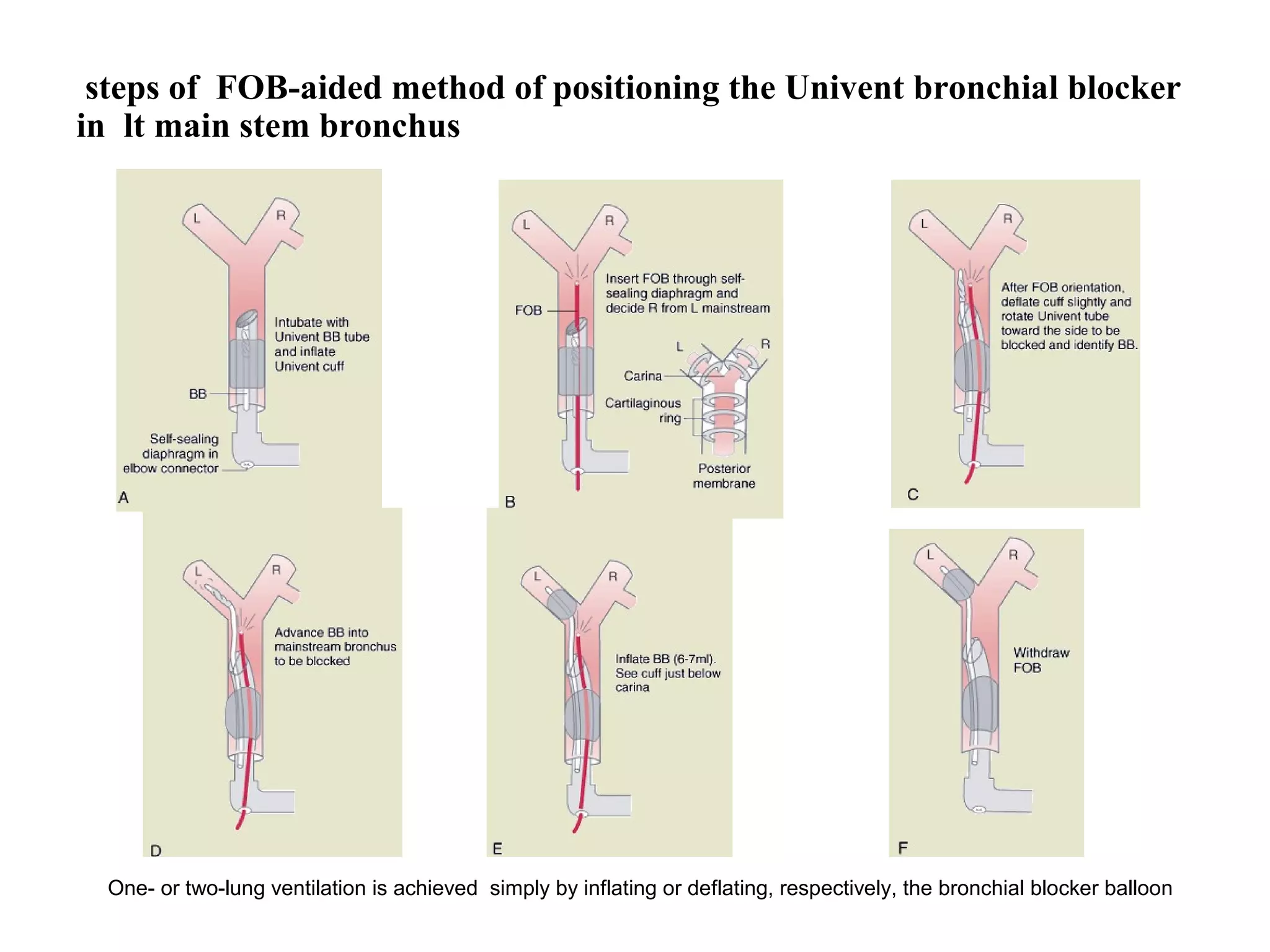 One lung ventilation | PPT
