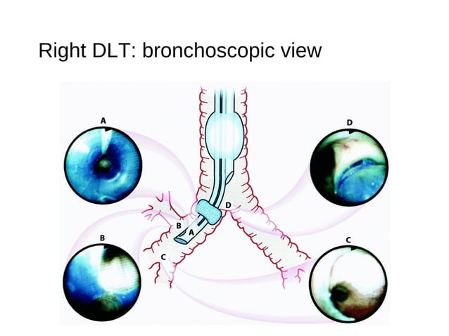 One lung ventilation | PPT | Lung and Respiratory Health | Diseases and ...