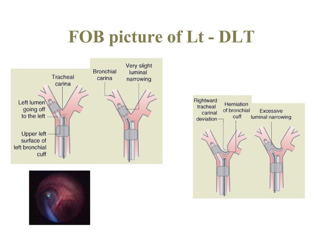 One lung ventilation | PPT | Lung and Respiratory Health | Diseases and ...