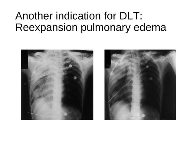 One lung ventilation | PPT | Lung and Respiratory Health | Diseases and ...