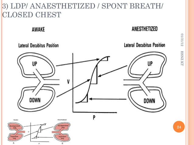 One lung ventilation kweq part 1 | PPT | Lung and Respiratory Health ...