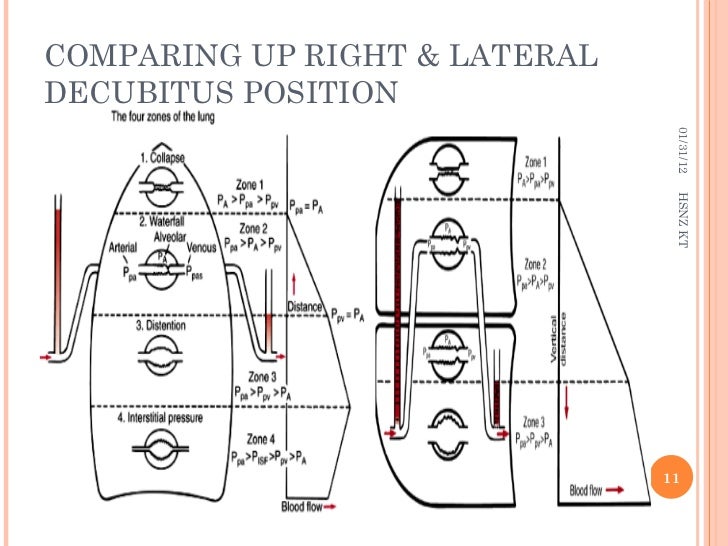 One lung ventilation kweq part 1