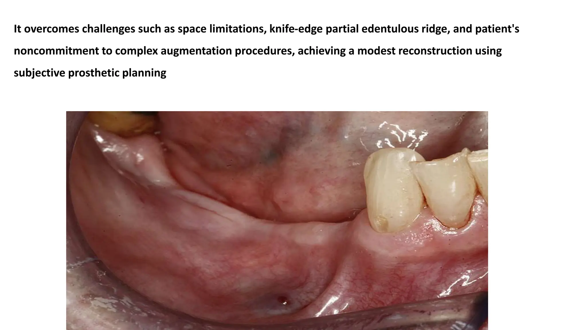 One piece compressive Dental implant : data from Google Scholar | PPTX