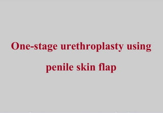 One stage urethroplasty using skin flap | PDF