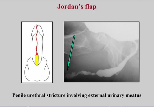 One stage urethroplasty using skin flap | PDF
