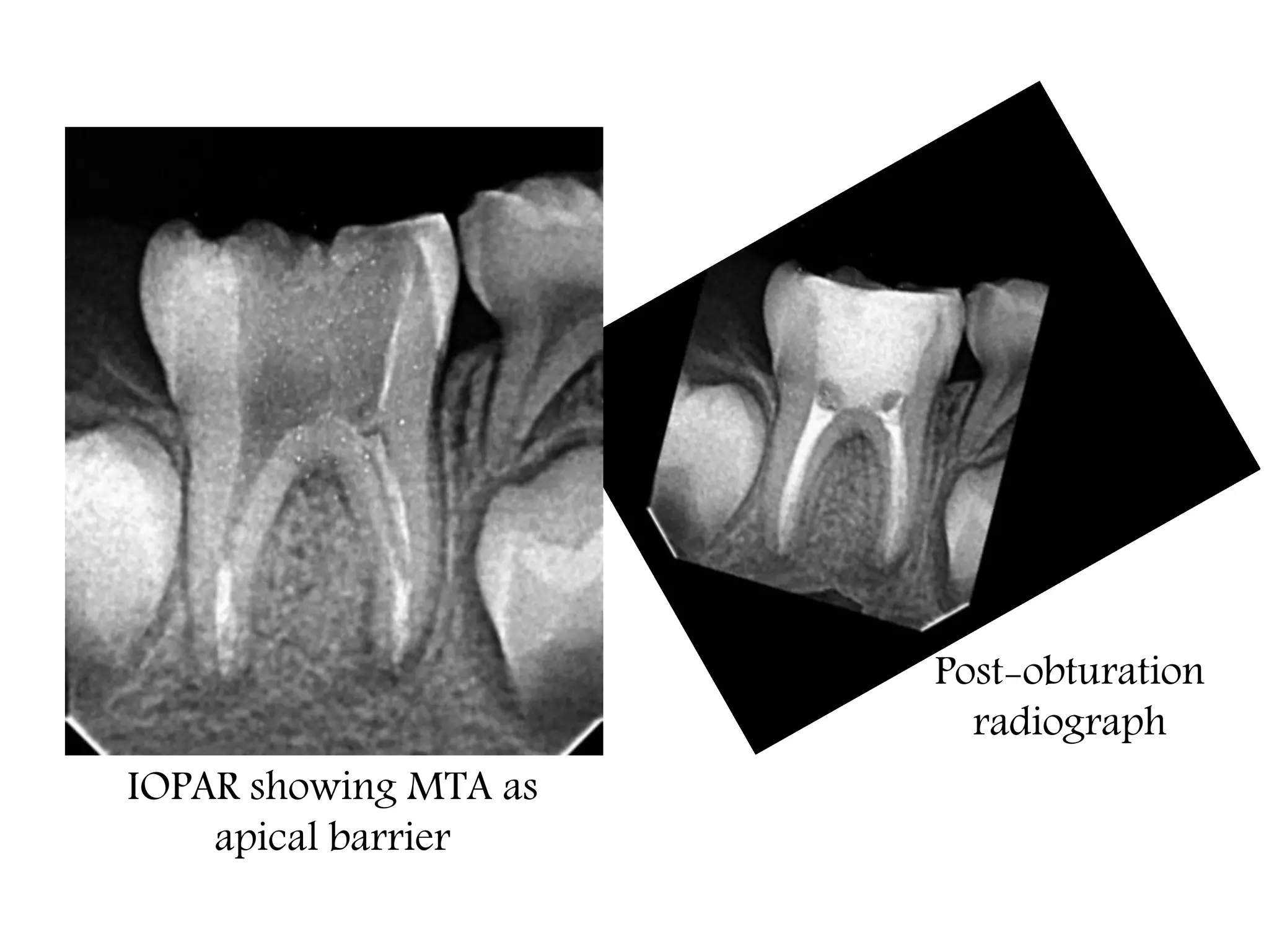 One step apexification | PPTX