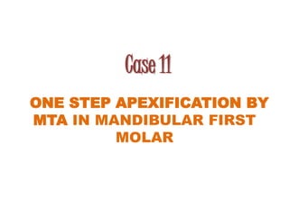 One step apexification | PPT