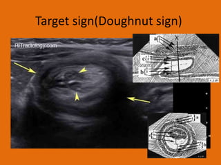 Ultrasound and intussusception..One stop station for diagnosis and ...
