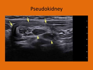 Intussusception Ultrasound Protocol