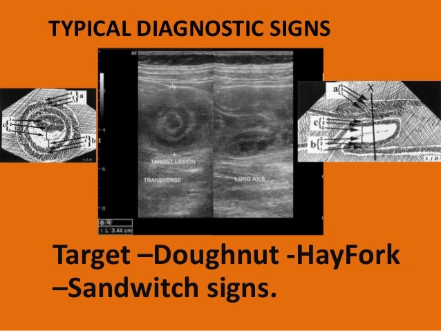 Ultrasound and intussusception..One stop station for diagnosis and re…