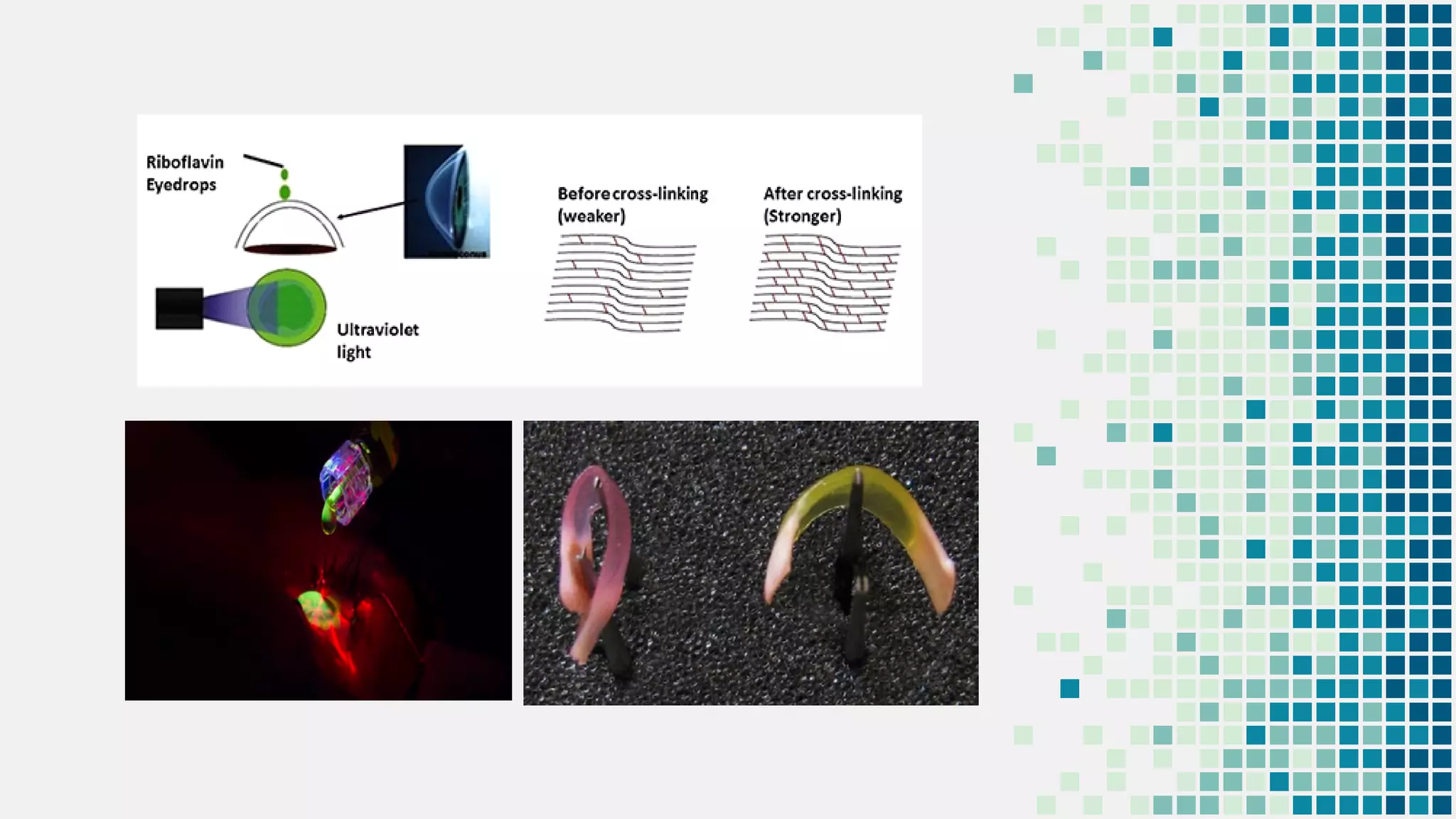 One way to optimize Corneal Cross linking (CXL) !! | PPT