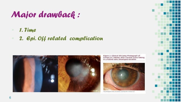 One way to optimize Corneal Cross linking (CXL) !! | PPT