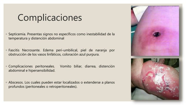Onfalitis | PPTX