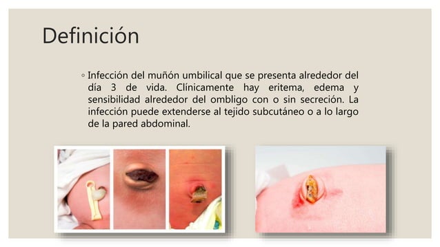 Onfalitis | PPTX